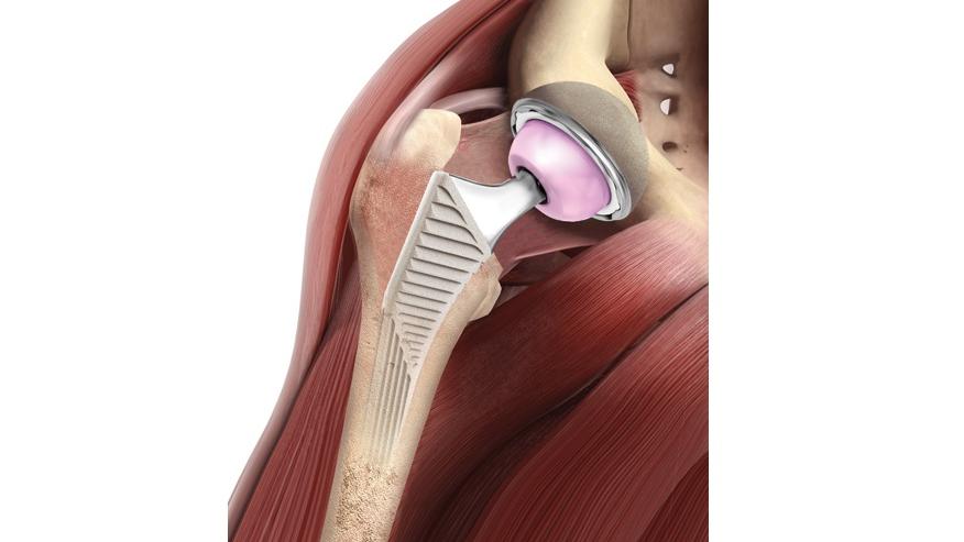 O que é uma Prótese da Anca? | Unidade da anca