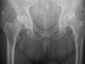 Porque realizamos a prótese da anca bilateral? | Unidade da anca