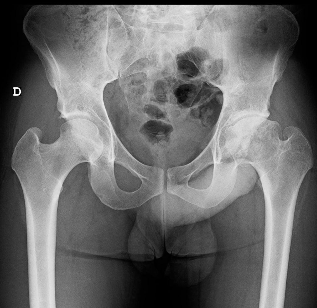 O que é uma Prótese da Anca? | Unidade da anca
